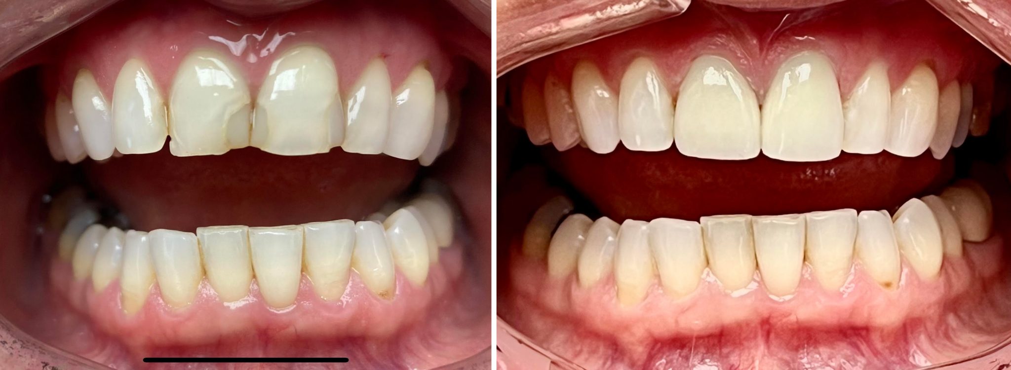 BEFORE AND AFTER TRANSFORMATIONS – Family Dentist Berks County Reading ...