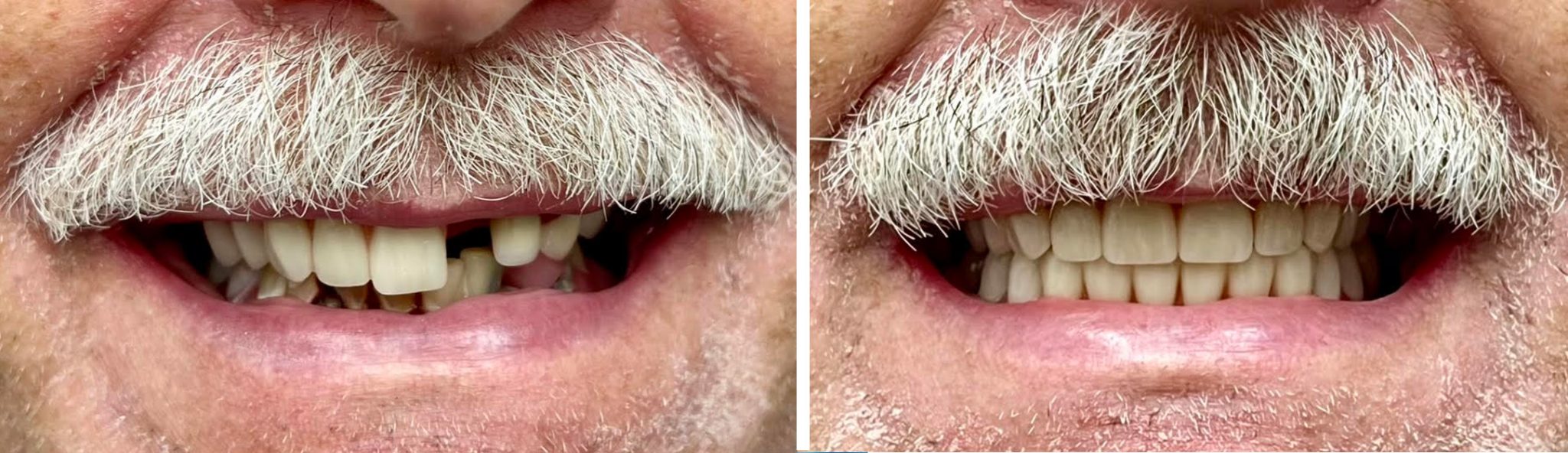 BEFORE AND AFTER TRANSFORMATIONS – Family Dentist Berks County Reading ...